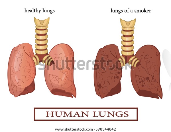 Healthy Sick Lung Table Vector Cartoon Stock Vector (Royalty Free ...