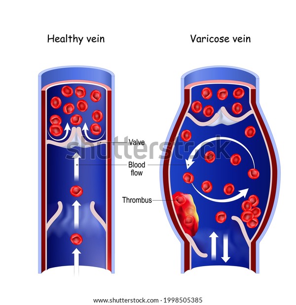 Healthy Vein Varicose Vein Cross Section Stock Vector (Royalty Free ...