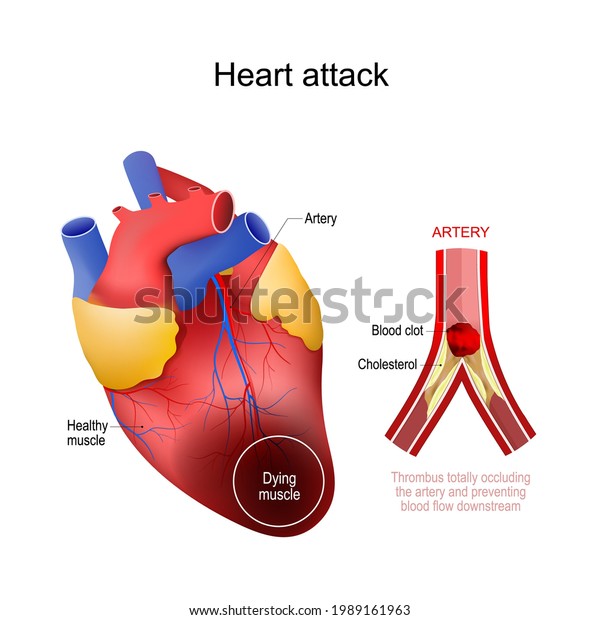 Heart Attack Myocardial Infarction Humans Heart: vetor stock (livre de ...