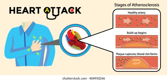 Heart Attack Vector Illustration Infographic Stock Vector (Royalty Free ...