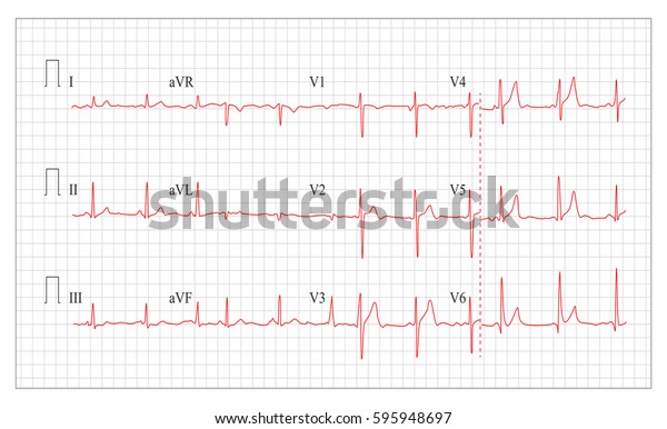 Heart Cardiogram Chart Vector Illustration Wave Stock Vector (Royalty ...