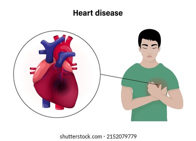 Heart Disease Vector Concept Man Heart Stock Vector (Royalty Free ...