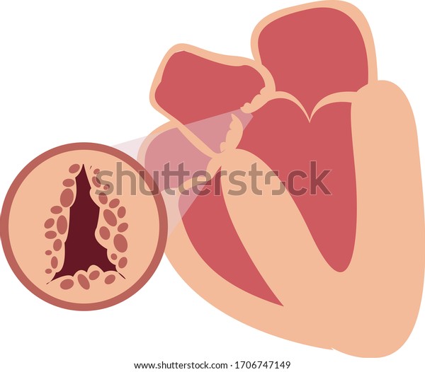 Heart Showing Aortic Stenosis Aortic Valve Stock Vector Royalty Free