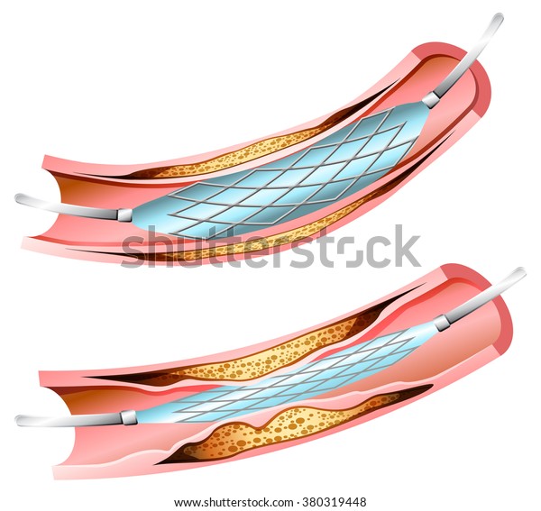 Heart Stent Illustration Stock Vector (Royalty Free) 380319448 ...