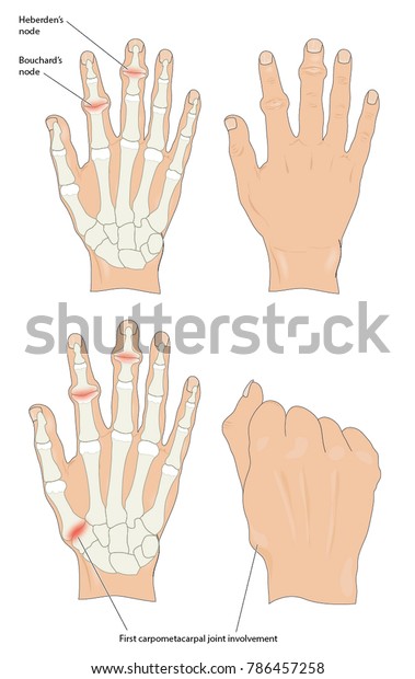 Heberdens Bouchards Nodes Osteoarthritic Hands Stock Vector (Royalty ...