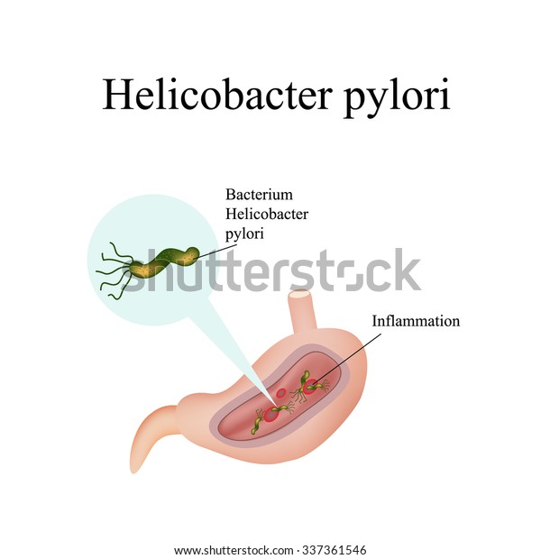 Helicobacter Pylori Stomach Infographics Vector Illustration Stock ...