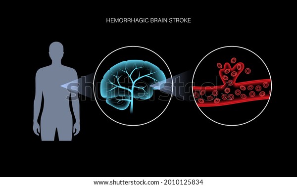 Hemorrhagic Brain Stroke Concept Apoplexy Cerebral Stock Vector ...