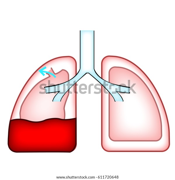 Hemothorax Lung Human Respiratory System Isolated Stock Vector (Royalty ...