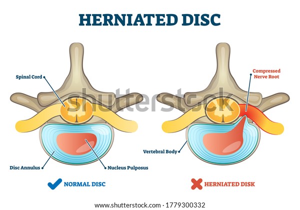 Herniated Disc Injury Labeled Spinal Pain Stock Vector (Royalty Free ...