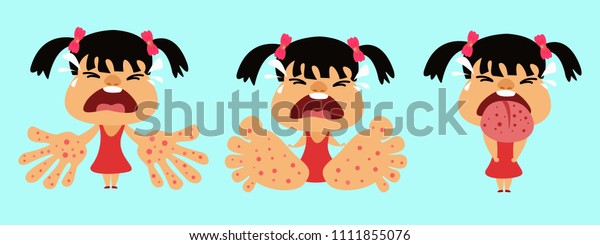 Hfmd Children Infected Hand Foot Mouth Stock Vector (Royalty Free ...