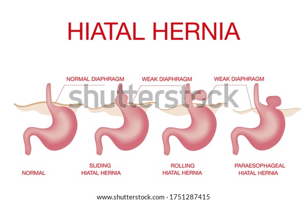 Vektor Stok Hiatal Hernia Vector Diagram Normal Anatomy (Tanpa Royalti ...