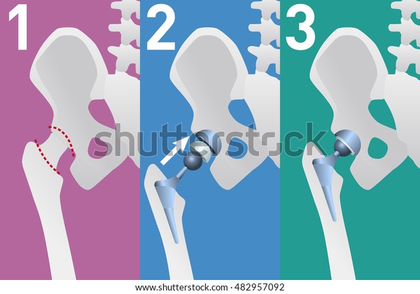 Hip Replacement Arthroplasty Diagram Vector Illustration Stock Vector ...