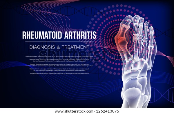 Horizontal Dark Blue Banner Arthritis Advertising Stock Vector (Royalty ...