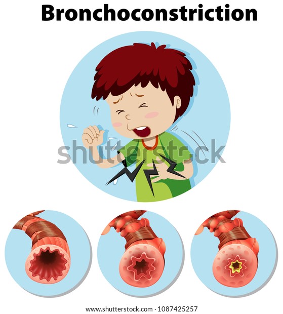 Stock vektor „Human Anatomy Bronchoconstriction On White Background ...