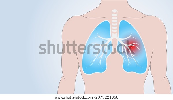 Human Body Icon Sick Lungs Various Stock Vector (Royalty Free ...