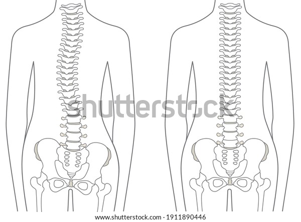Human Body Normal Spine Distorted Spine Stock Vector (Royalty Free ...