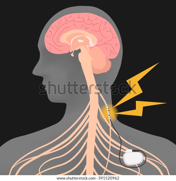 Human Brain Vagus Nerve Stimulationvns Image Stock Vector (Royalty Free ...