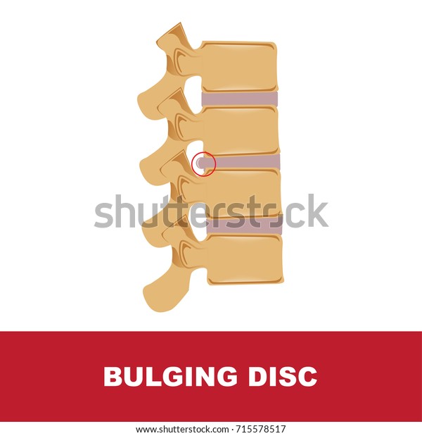 Human Disc Degeneration Bulging Disc Stock Vector (Royalty Free) 715578517