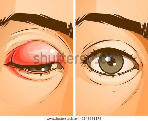 Human Eye Stye Chalazion Before After: เวกเตอร์สต็อก (ปลอดค่าลิขสิทธิ์ ...