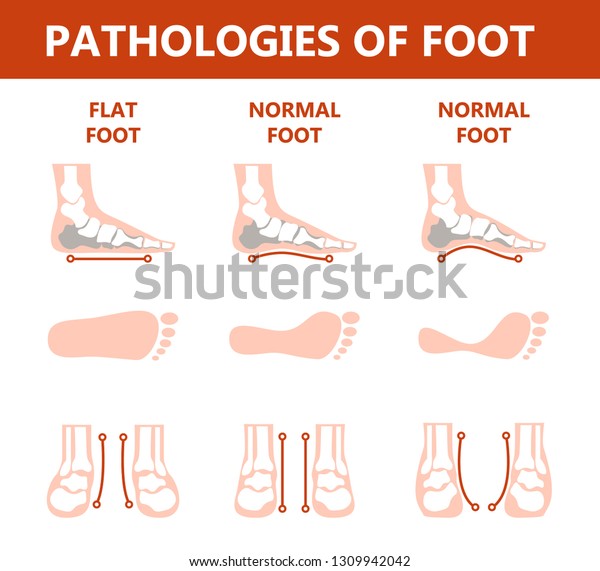 Human foot pathologies infographic. Flat foot anatomy. Deformed and ...