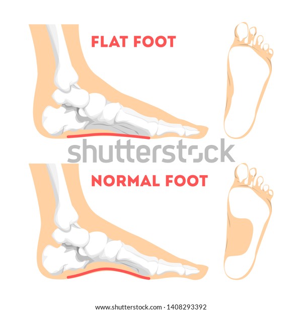 Human Foot Pathology Infographic Flat Foot Stock Vector (Royalty Free ...