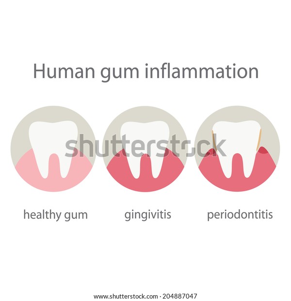 Human Gum Inflammation Eps 10 Vector 스톡 벡터(로열티 프리) 204887047