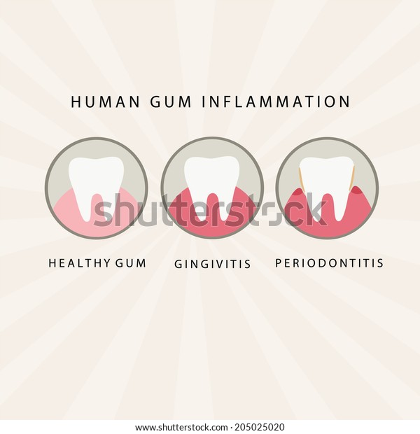「Human Gum Inflammation Eps 10 Vector」のベクター画像素材（ロイヤリティフリー） 205025020 ...