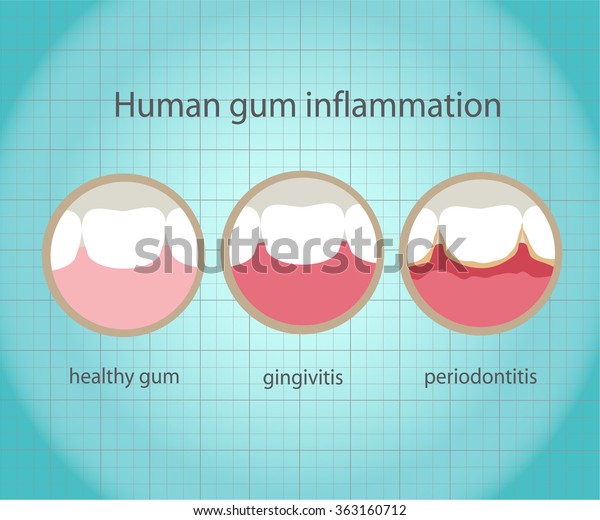 Vector de stock (libre de regalías) sobre Human Gum Inflammation Eps 10 ...