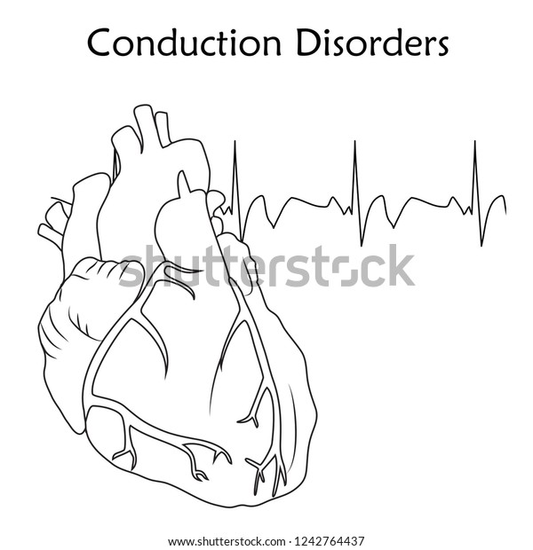 Human Heart Conduction Disorders Anatomy Flat: Vector có sẵn (miễn phí ...
