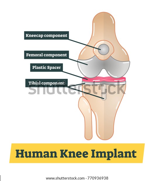 Human Knee Implant Vector Diagram Illustration Stock Vector (Royalty ...