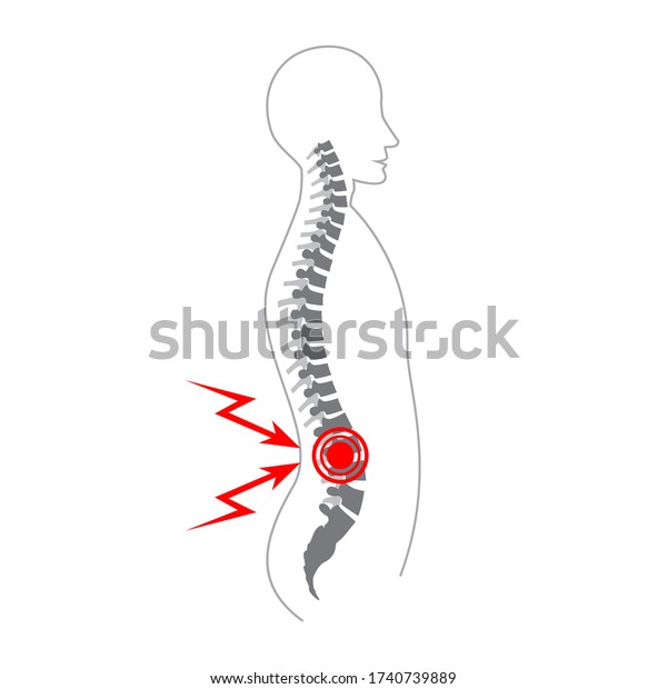 Human Spine Pain Vector Illustration Medical Stock Vector (Royalty Free ...