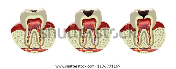 Human Tooth Decay Disease Cross Section Stock Vector (Royalty Free ...