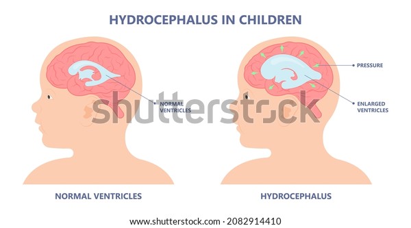 Hydrocephalus Brain Cerebrospinal Fluid Csf Drain Stock Vector (Royalty ...