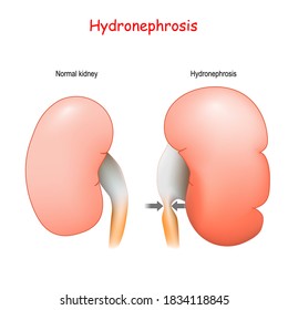 572 Hydronephrosis Images, Stock Photos & Vectors | Shutterstock