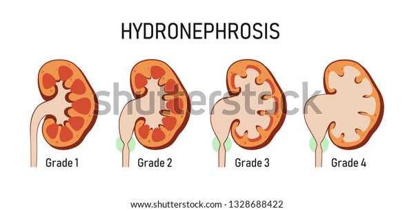 Hydronephrosis Stage Vector Illustration Stock Vector (Royalty Free ...
