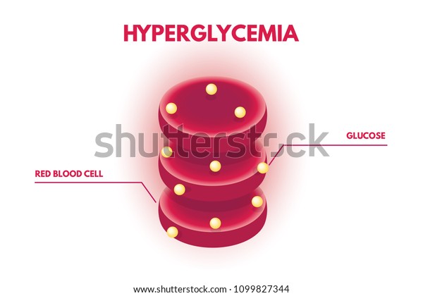 Hyperglycemia Human Glucose Levels Isometric Vector Stock Vector ...