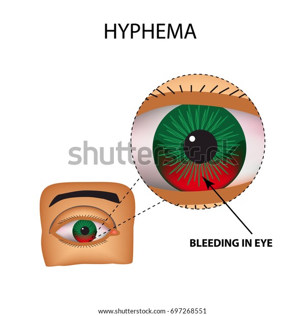 Hyphema Anterior Eye Hemorrhage Structure Eye Stock Vector (Royalty ...
