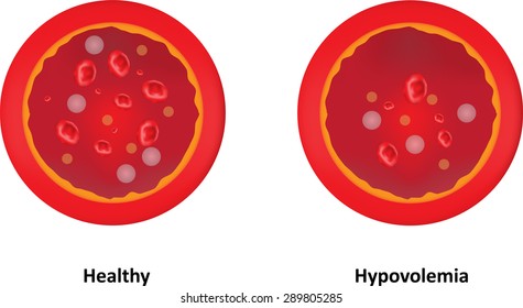 7 Hypovolemic shock vector Images, Stock Photos & Vectors | Shutterstock