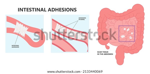 Ileus Bowel Toxic Small Midgut Cecal Stock Vector (Royalty Free ...