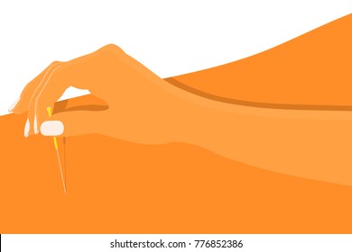 Illustration Acupuncture Hand Needle Acupuncture: vector de stock ...