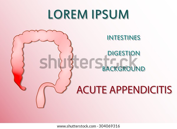Illustration Acute Appendicitis Intestines Bowel Stock Vector (Royalty ...