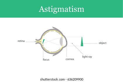 Astigmatism eye Images, Stock Photos & Vectors | Shutterstock