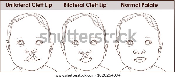 Illustration Cleft Palate Child Plastic Surgery 스톡 벡터(로열티 프리 ...