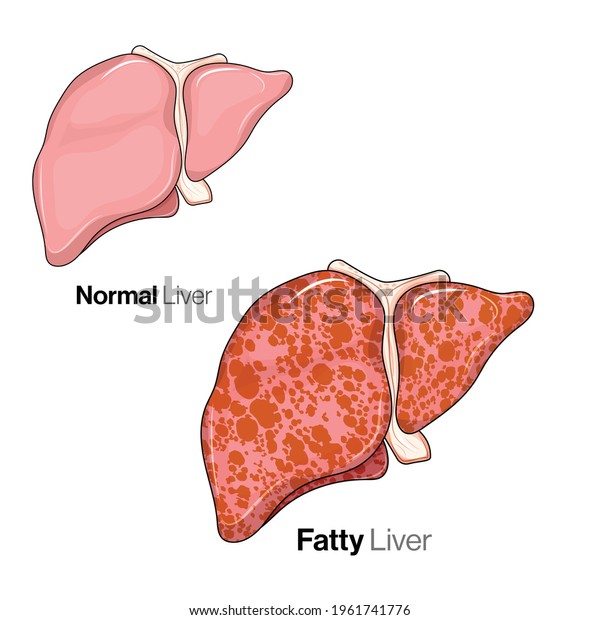 Illustration Comparison Normal Fatty Liver Disease Stock Vector ...