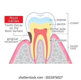 Illustration Cross Section Root Caries Since Stock Vector (Royalty Free ...