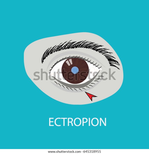 Illustration Eye Disease Ectropion Stock Vector (Royalty Free ...