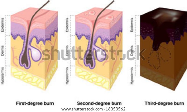 Illustration First Second Thirddegree Burns Stock Vector (Royalty Free ...