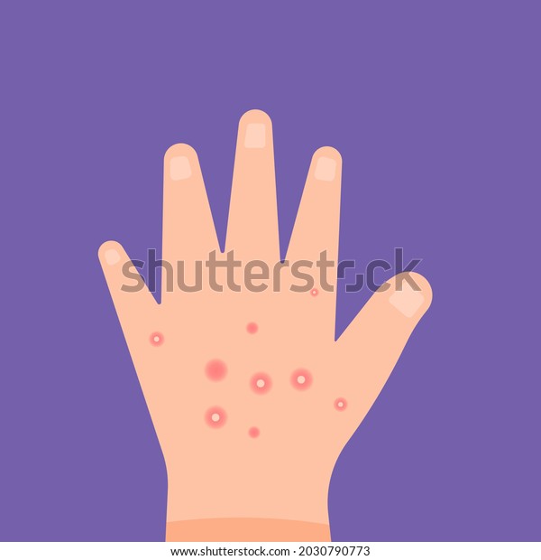 Illustration Hands Affected By Skin Diseases Stock Vector (Royalty Free ...