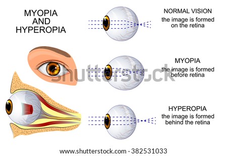 Illustration Healthy Eye Eye Myopia Hyperopia Stock Vector (Royalty ...