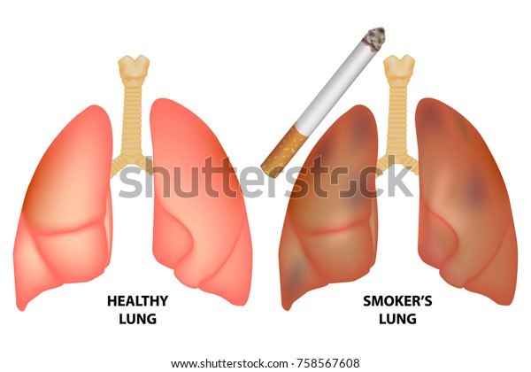 Illustration Healthy Lungs Lungs Smoker Stock Vector (Royalty Free ... Illustration Healthy Lungs Lungs Smoker Stock Vector (Royalty Free ...